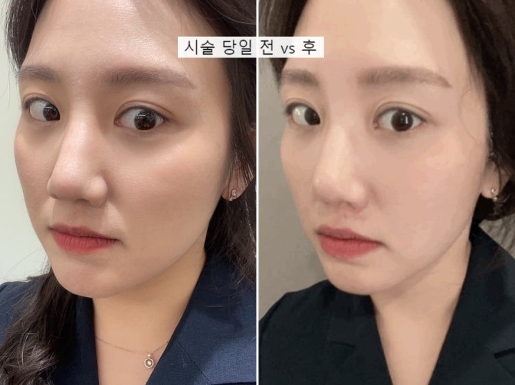 티타늄리프팅 가격 즉각적인 효과 본 리얼후기 네이버 블로그