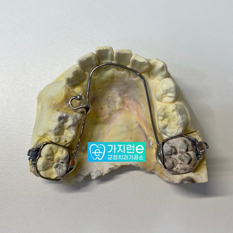 lingual arch + hook추가 한 장치입니다. : 네이버 블로그