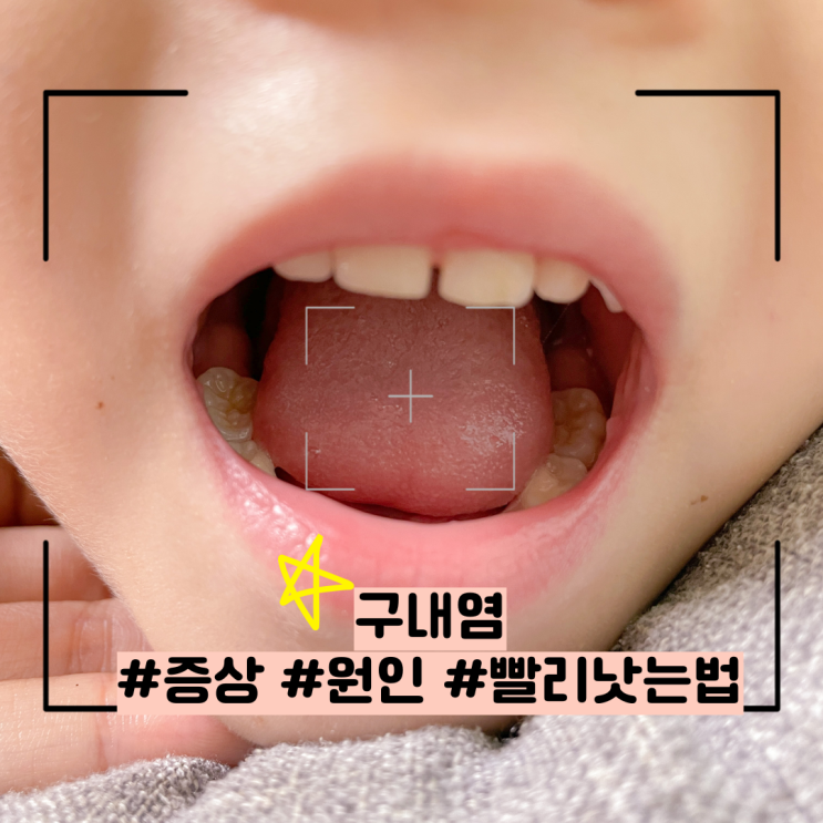 아기 구내염 전염 원인 증상 빨리낫는법 연고 약 어린이집 네이버 블로그