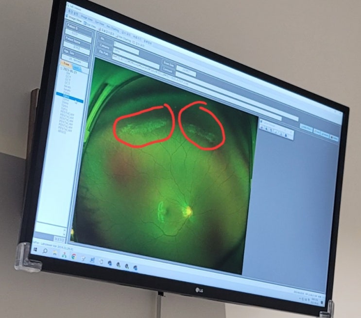 후기 스마일라식 일주일 후기 망막 격자 변성 레이저 치료 후기 비용 고통 주의점 준비물 네이버 블로그