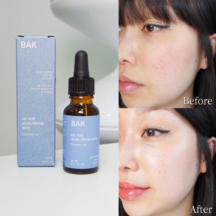 여드름 피부 바르는 유산균 화장품 BAK 과학기반 스킨케어 : 네이버 블로그