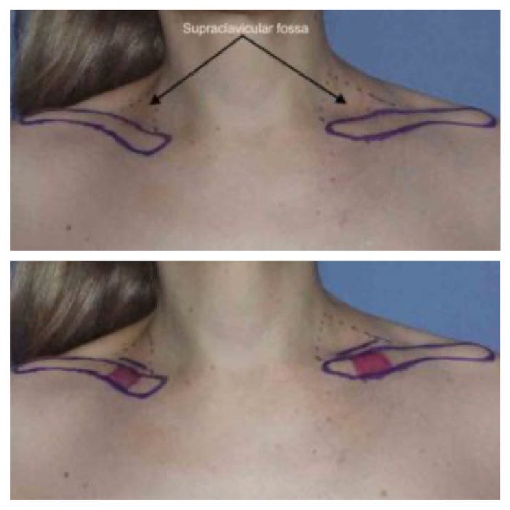 어깨 축소수술 Clavicle shortening surgery _ 여성 체형 쇄골 축소 : 네이버 블로그