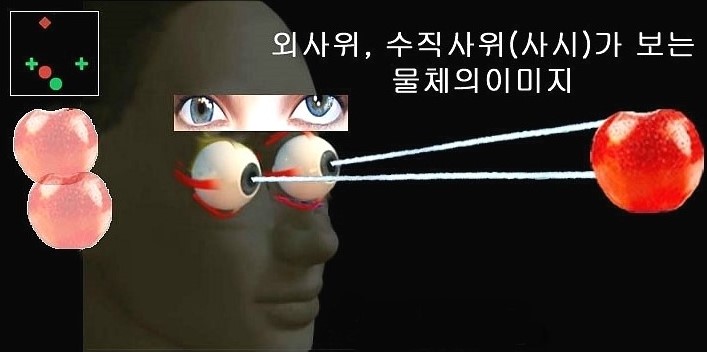 눈의 초점을 맞추기 힘들때” ‘사위란 ‘검안 전문 안경원 비엔나 안경원 마곡 안경원 발산역 안경원 네이버 블로그