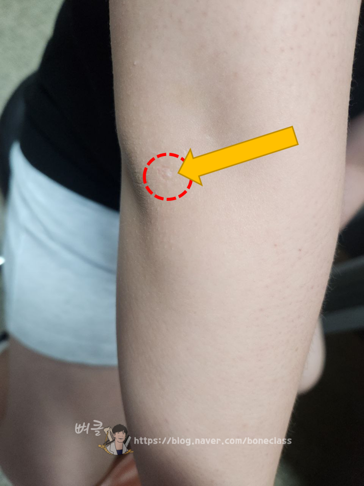소아정형외과 상완골 과상부 골절의 상처 소아 팔꿈치 골절 핀 고정술 상처 치유 과정 네이버 블로그