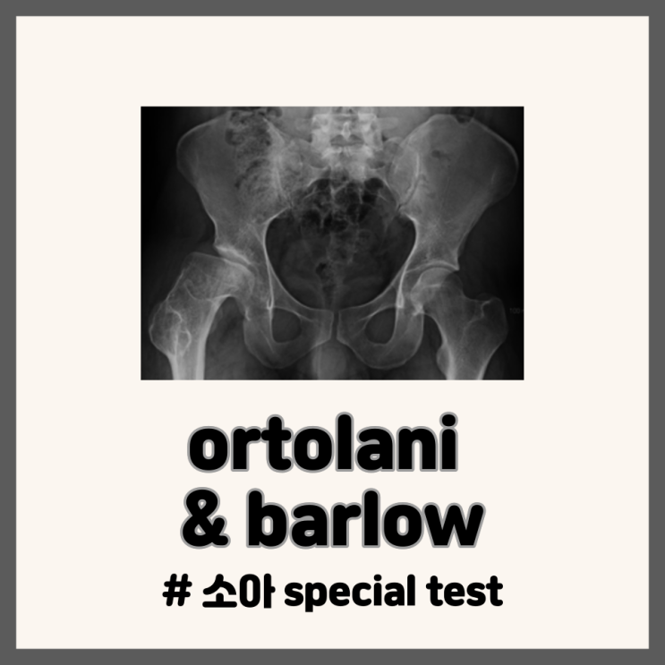 레그-칼베-페르테스병ortolani barlow tese : 오토라니 바로우 검사 CDH DDH 선천성 엉덩관절탈구 ...