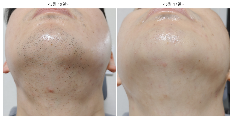 창원 남자 수염 레이저 제모 3회차 후기 찐 내돈내산 젠틀맥스 네이버 블로그