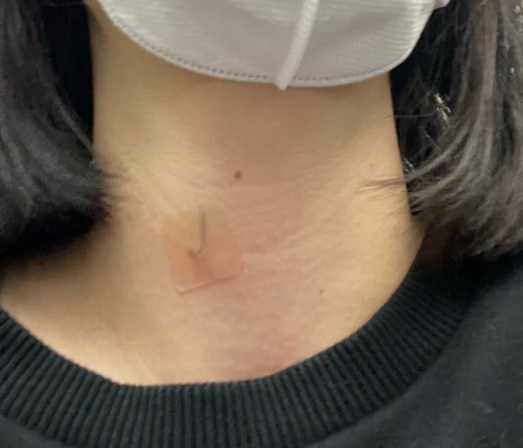 1편 30살의 수술/ 갑상선암 / 갑상선암수술 / 갑상선암후기 / 암수술 : 네이버 블로그