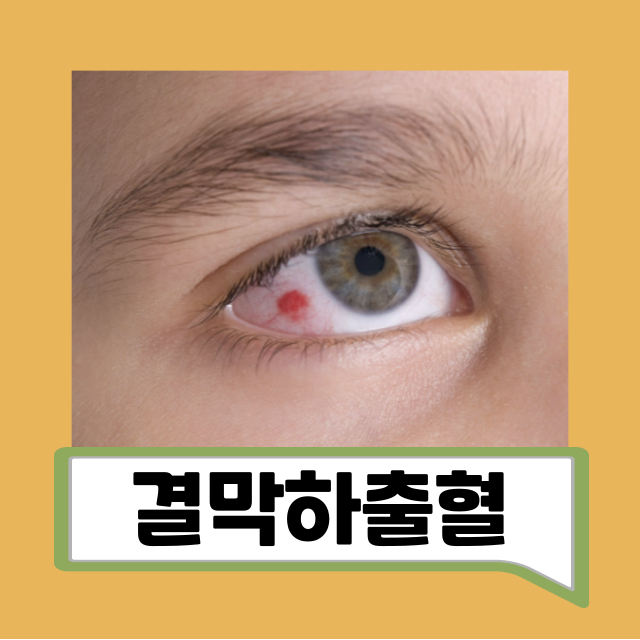 결막하출혈 원인 및 치료 눈 혈관 터짐 한쪽눈 충혈 안구출혈 차이점 네이버 블로그