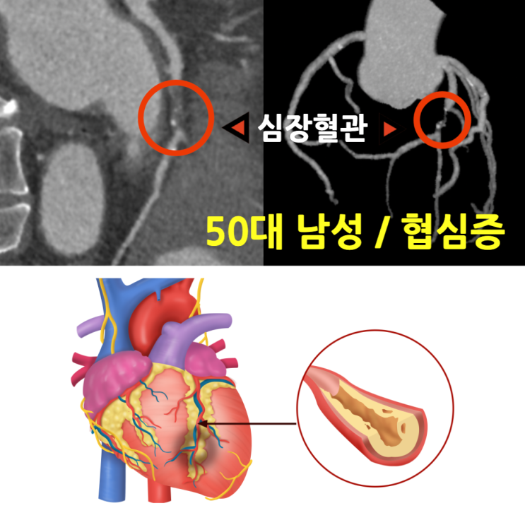 왼쪽 가슴이 찌릿 뻐근 답답한 증상 그리고 심장통증 가볍게 넘기지 마세요 네이버 블로그