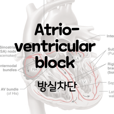 방실차단 Atrioventricular block, AV block : 네이버 블로그