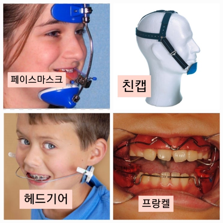 사용기 어린이 부정교합 치료첫번째 이야기feat교정선택이유주걱턱교정방법성장기교정장치교정시기교정전문병원 네이버 블로그