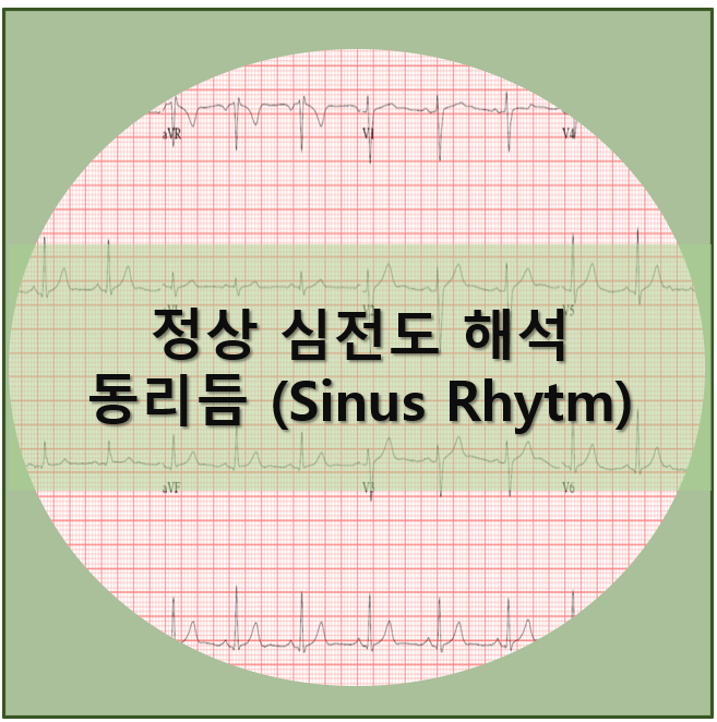 EKG 해석과 정상 동리듬 Normal Sinus Rhythm, NSR 의학용어 개념 : 네이버 블로그