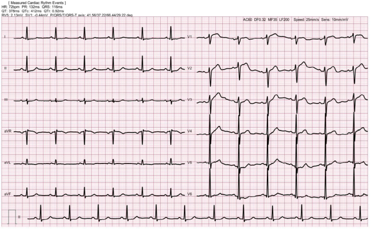 심전도 V4-V5, I, aVL leads ST segment depression and T wave inversion → ...