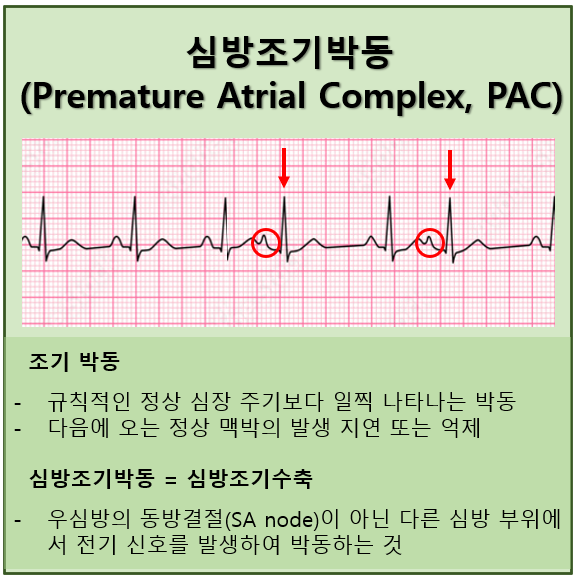 심방 조기수축 (Premature Atrial Contraction/ Complex, PAC, APC) 의학용어 심방 조기 박동 ...