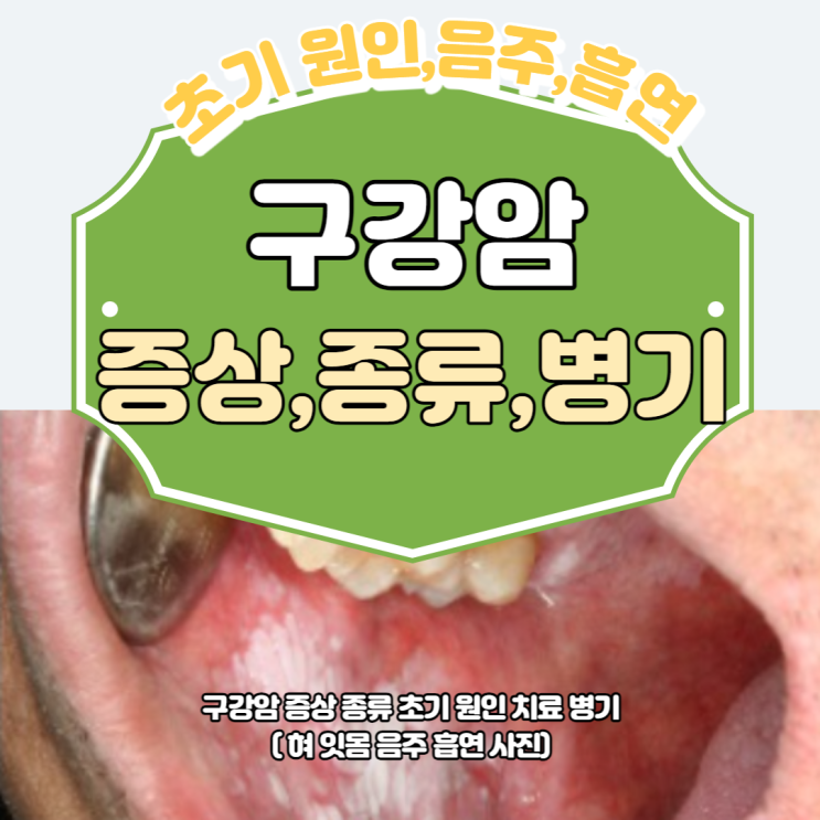 구강암 증상 종류 초기 원인 치료 병기 혀 잇몸 음주 흡연 사진 네이버 블로그
