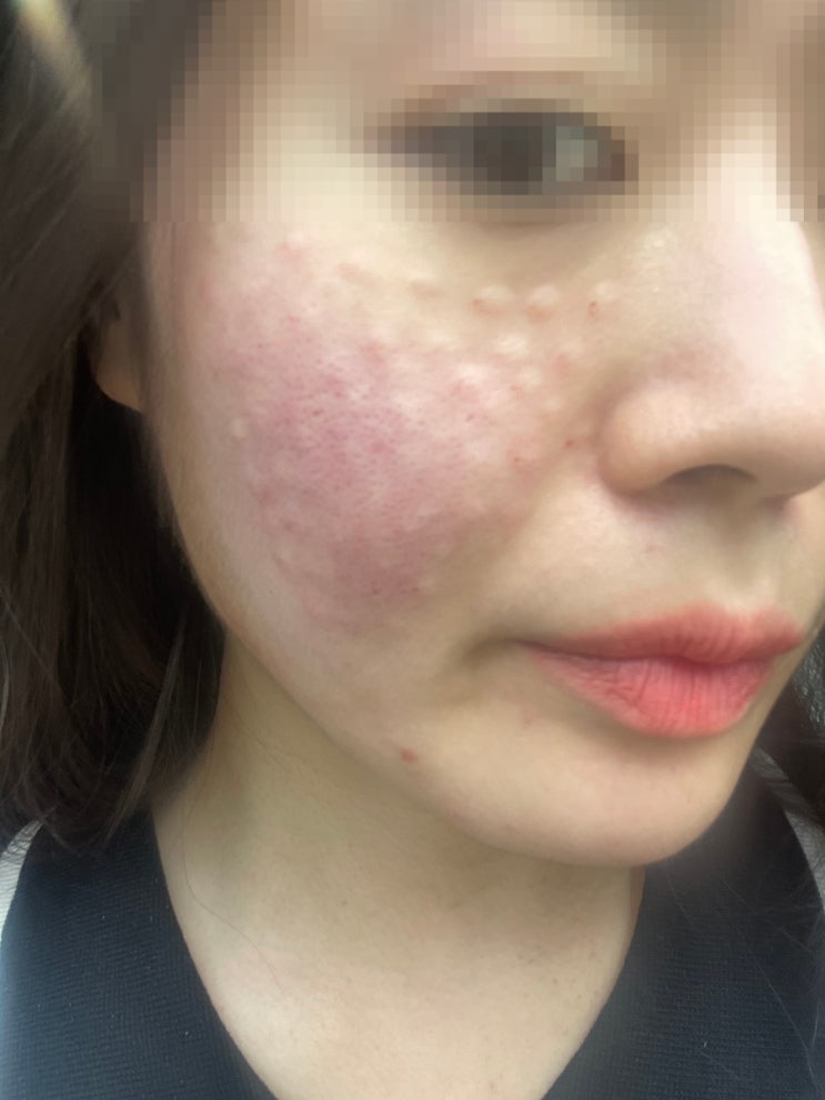 물광주사 통증 효과 가격 멍 +피부염/아토피 피부 후기 : 네이버 블로그