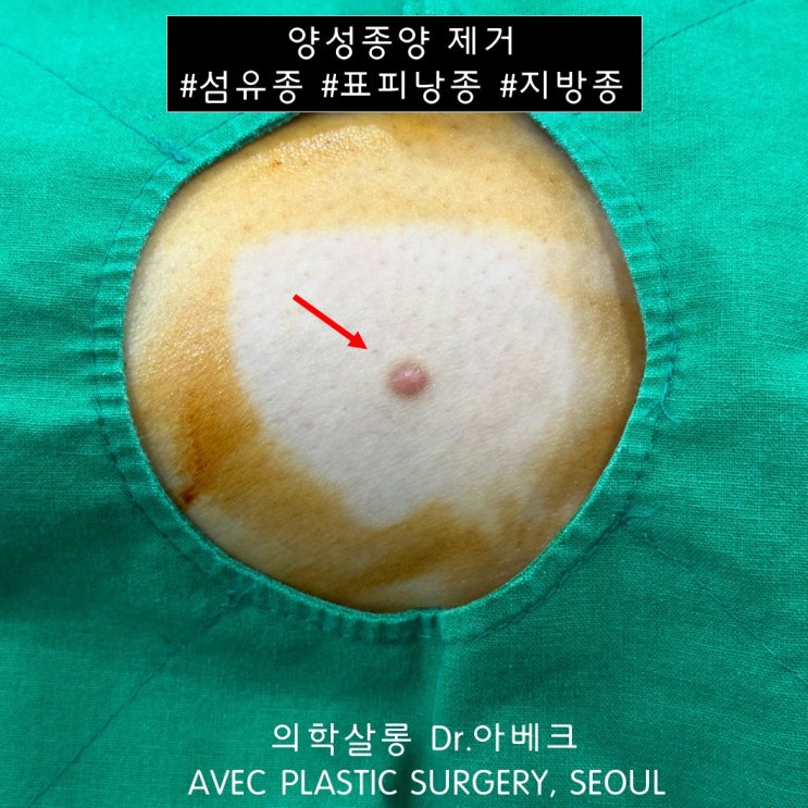 피부섬유종 허벅지 혹 제거 수술 사례 【dr 아베크 양성종양】 네이버 블로그