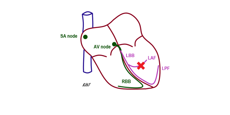 Left anterior fascicular block (좌각 전섬유속 차단, LAFB) : 네이버 블로그