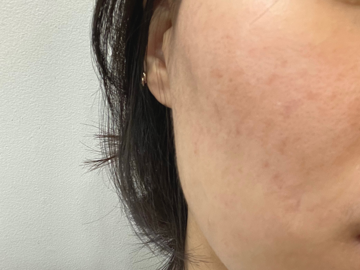 모낭염 좁쌀여드름 한의원에서 해결하는 중 1탄 미노씬 이소티논 에스로반 다 써봄 네이버 블로그
