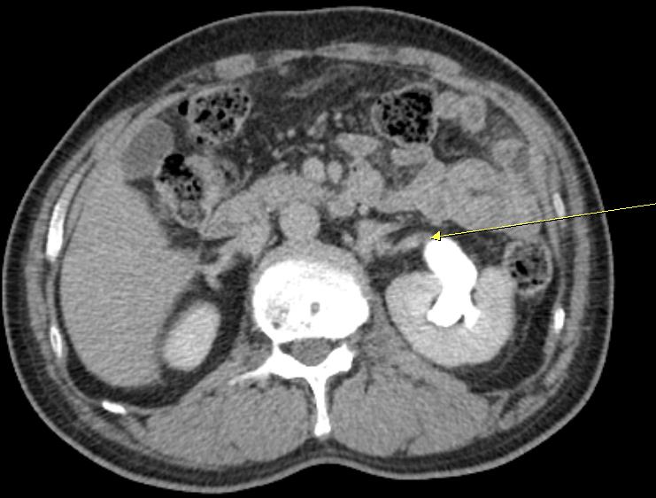 요관협착(ureteral obstruction) : 네이버 블로그