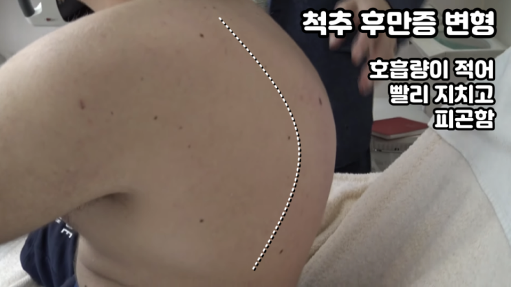 373. 척추 후만증 KSNS KSS 스본 스도 4번 60% 변화 : 네이버 블로그