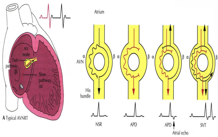 심전도 ECG/EKG SVT(1) - AVNRT, AVRT : 네이버 블로그