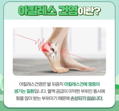 아킬레스건염 원인 및 증상 And 런닝 후 아킬레스건염 치료방법 육상선수 아킬레스 건염 치료방법 네이버 블로그