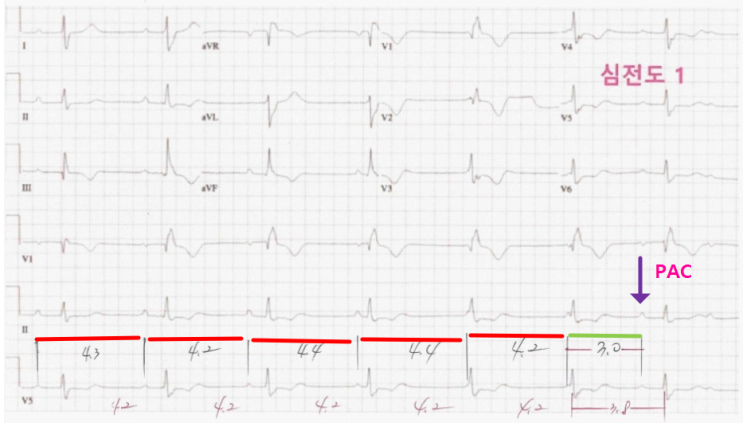 심전도, High grade AV block, Complete AV block, AF with complete heart ...
