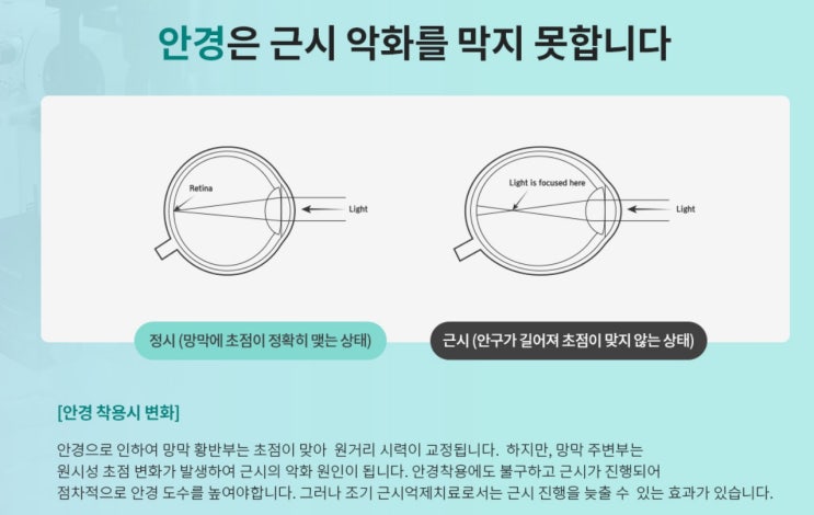 고도근시 드림렌즈 Or 마이사이트렌즈 어떤 것이 좋을까요 광명 시흥 안양 부천 드림렌즈안과 소아안과 네이버 블로그