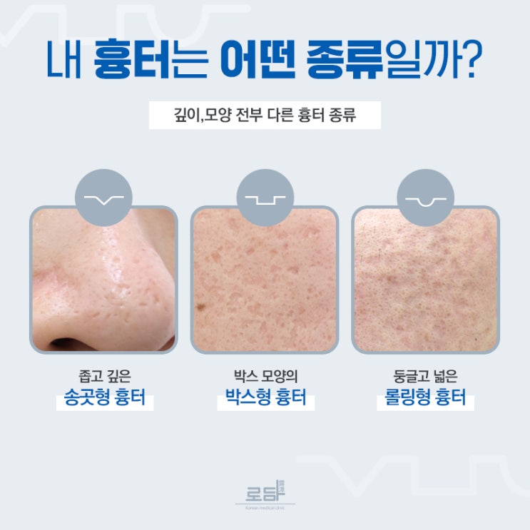 부산여드름흉터한의원 종류별로 맞춤 시술이 필요한 이유 네이버 블로그