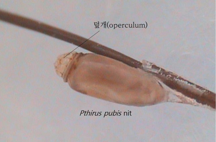 사면발니(사면발이) 서캐의 형태 The shape of Pthirus pubis nit : 네이버 블로그