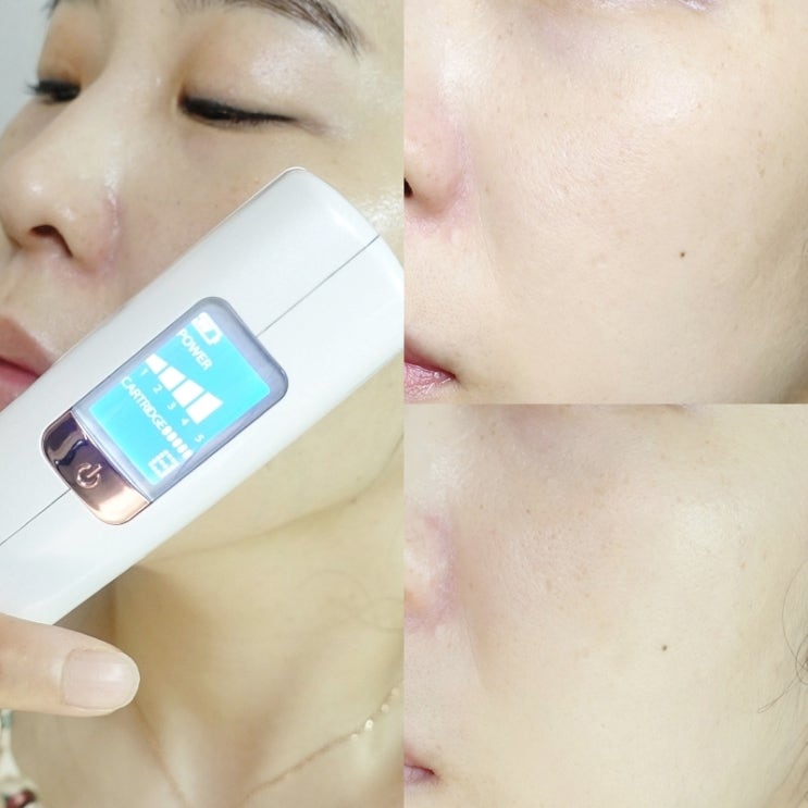 피부관리기 홈쎄라 비교 후 고른 아띠베뷰티 한 달 뒤 탄력 변화는 네이버 블로그