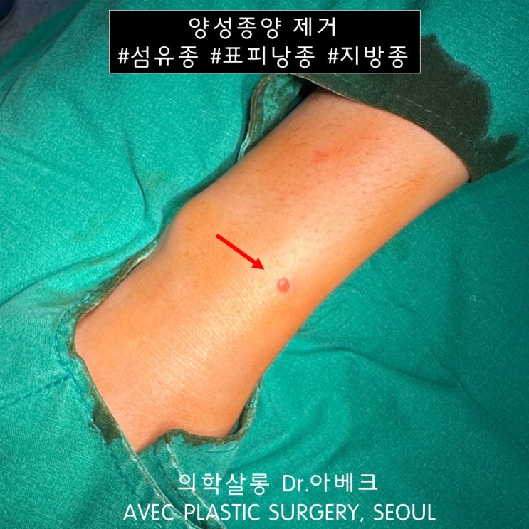 손목 섬유종 제거 피부섬유종 흉터관리 【dr 아베크 양성종양】 네이버 블로그