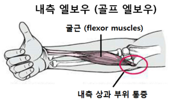 골프 엘보 팔꿈치 안쪽 통증 신정네거리 에스짐 신정네거리 피티 신정네거리 헬스 신정 네거리 재활 신정 네거리 Pt