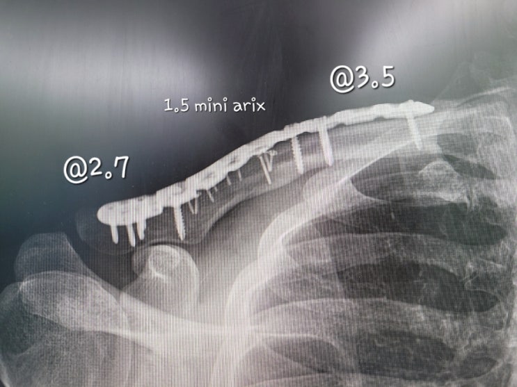 OS) clavicle plate remove (prof.W) : 네이버 블로그