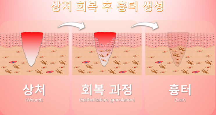 ★성형 후 관리약★ 2탄 흉터치료제 종류 및 복용사용법리자벤캡슐 콘투라투벡스노스카나겔 더마틱스울트라센스카스카논겔