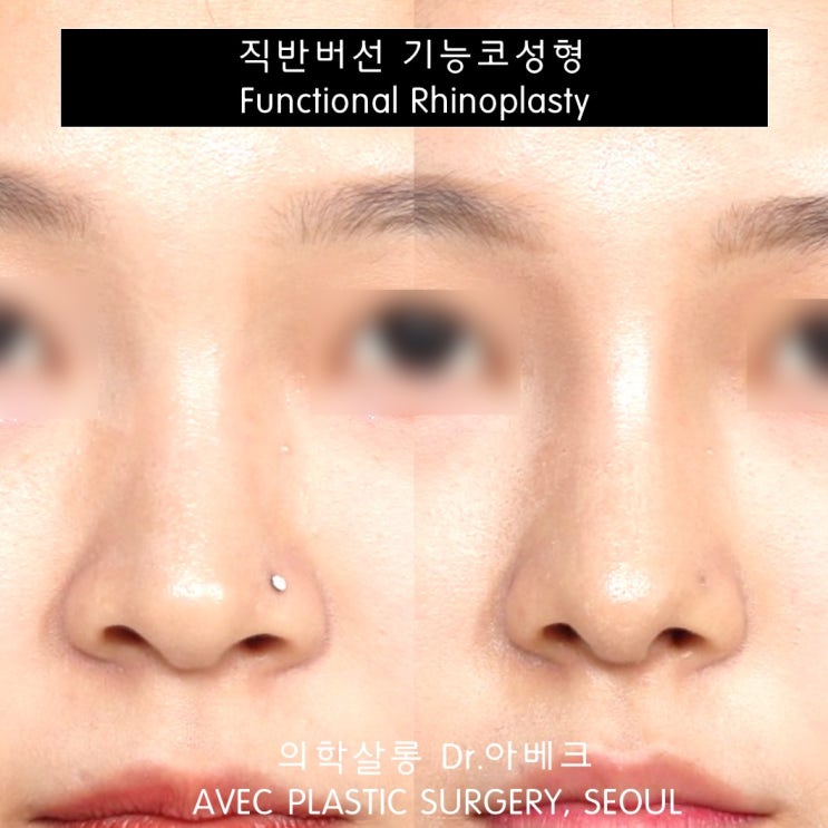 비염과 코성형을 한 번에 해결 기능코수술 무보정 사례 【dr 아베크 코성형】 네이버 블로그