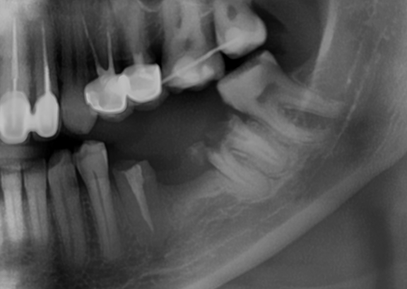 [증례] Hypercementosis(과백악질화)된 Root rest(잔존 치근)의 발치 : 네이버 블로그