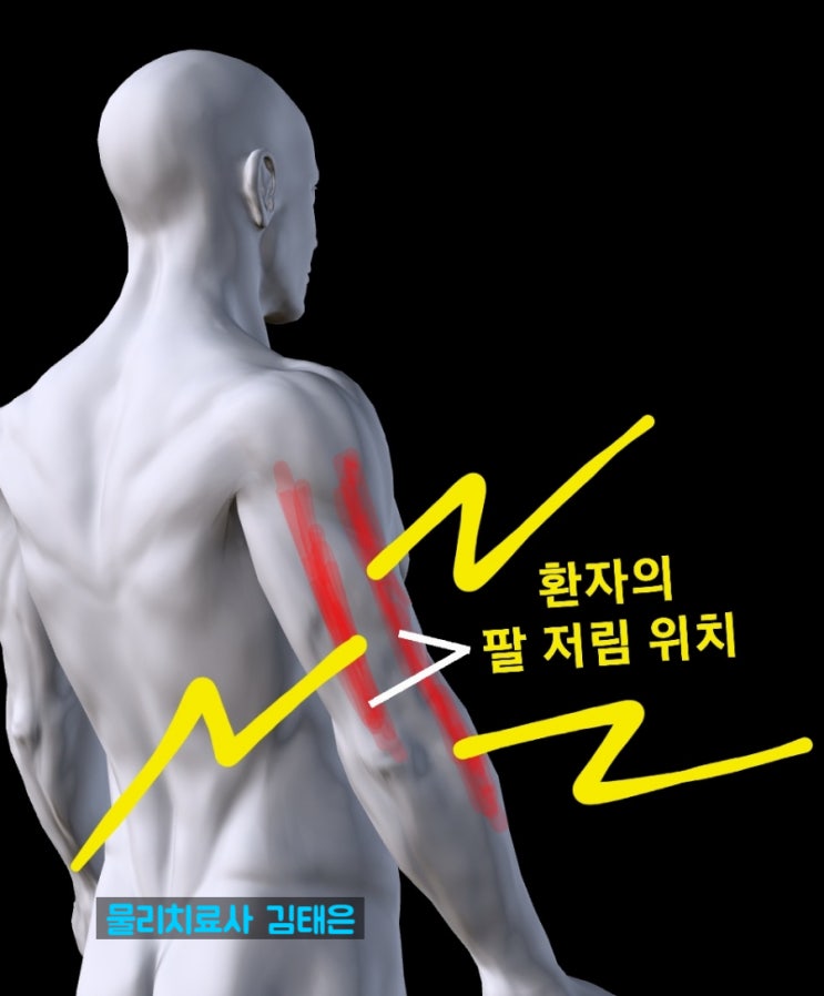 팔이 저려요 - 요골신경 포착(Radial nerve entrapment) - ULTT(Upper limb tension ...