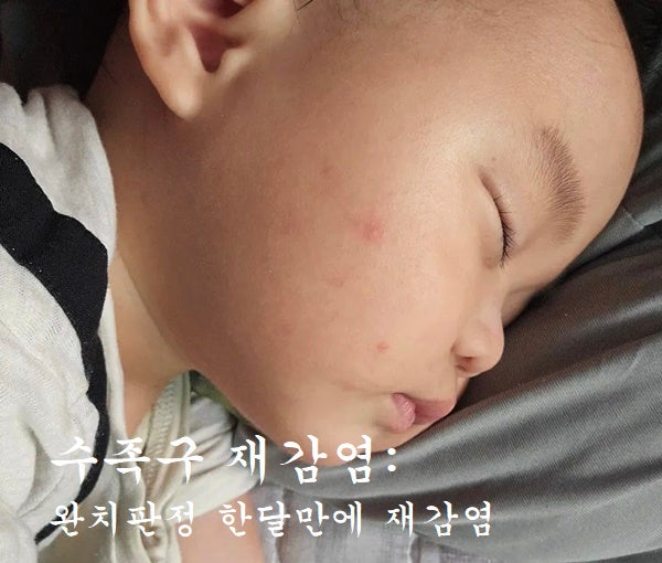수족구 한달만에 재감염 14개월 아기 증상 치료 네이버 블로그