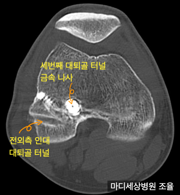 전방십자인대 재수술 (revision ACLR)이란? #3 성공율을 높이기 - 골이식 없이 대퇴골 견고한 고정과 반월상 연골 ...