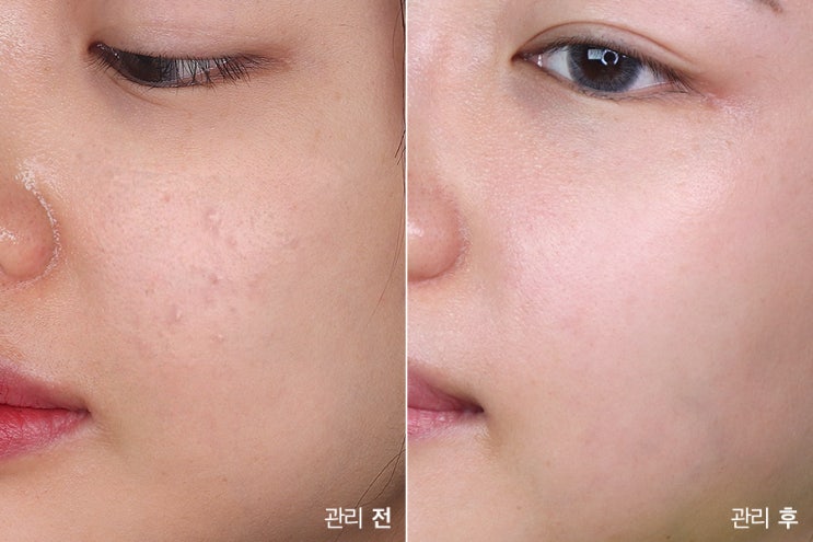 볼 좁쌀여드름 없애기 2달 후기 네이버 블로그