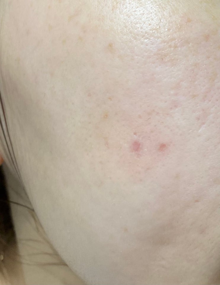 천안새살침 코라테라피 두번째 진료 : 네이버 블로그