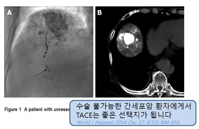 간세포암의 경동맥화학색전술(TACE)에 대해 알아봐요 : 네이버 블로그