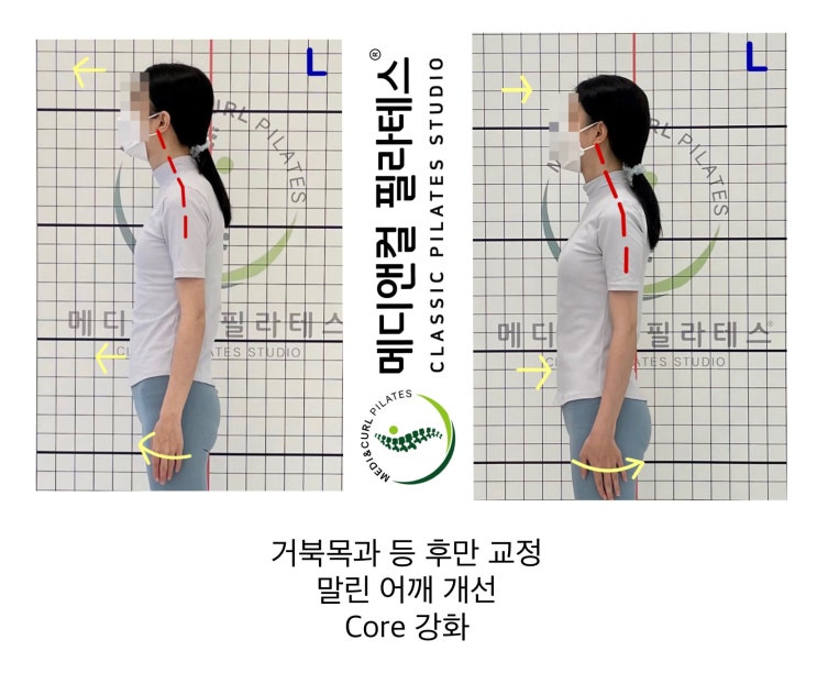 괘법동필라테스사상필라테스메디앤컬필라테스 거북목 비포에프터 재활필라테스개인레슨 네이버 블로그