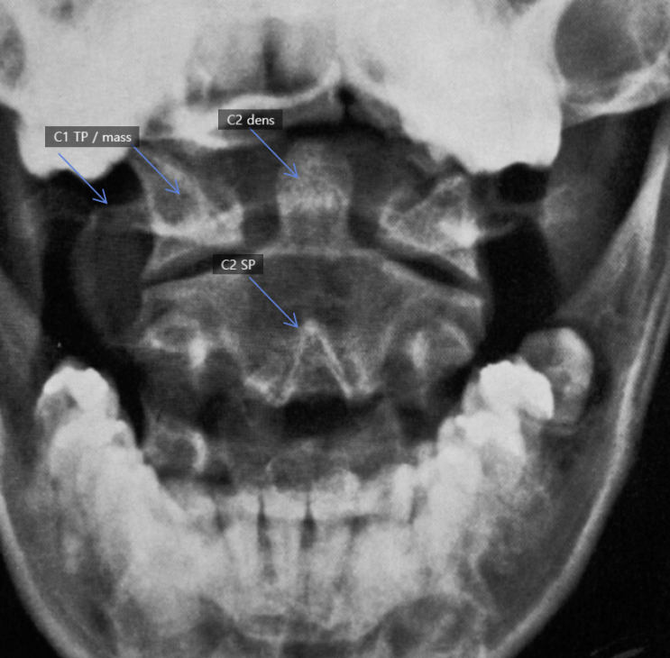 Open mouth view 상부 경추 평가 및 치료!! : 네이버 블로그
