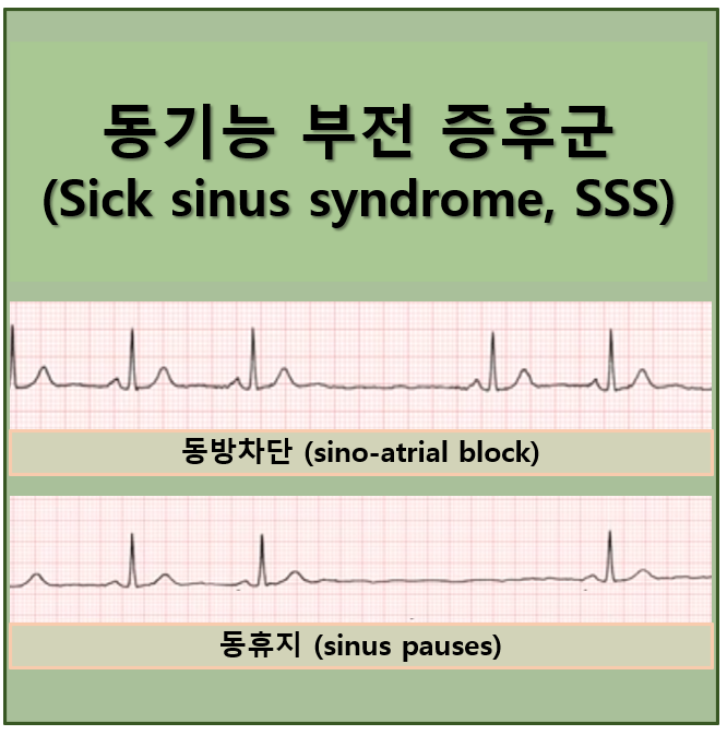 동기능 부전 증후군 (Sick sinus syndrome, 의학용어 SSS) 알기 쉬운 총정리 : 네이버 블로그