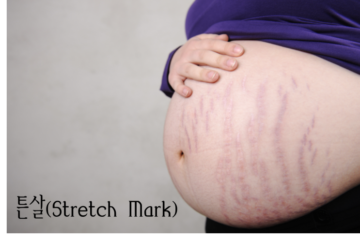 피부과 전문의와 알아보는 튼살(Stretch Mark, Striae) 해결방법 : 네이버 블로그