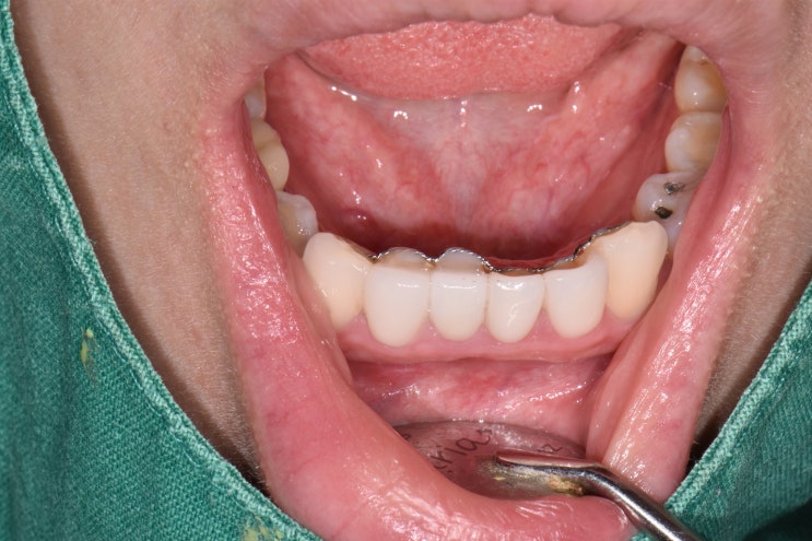 뿌리끝 병소 올세라믹 크라운 재치료 크라운마진수정 ridge lap : 네이버 블로그