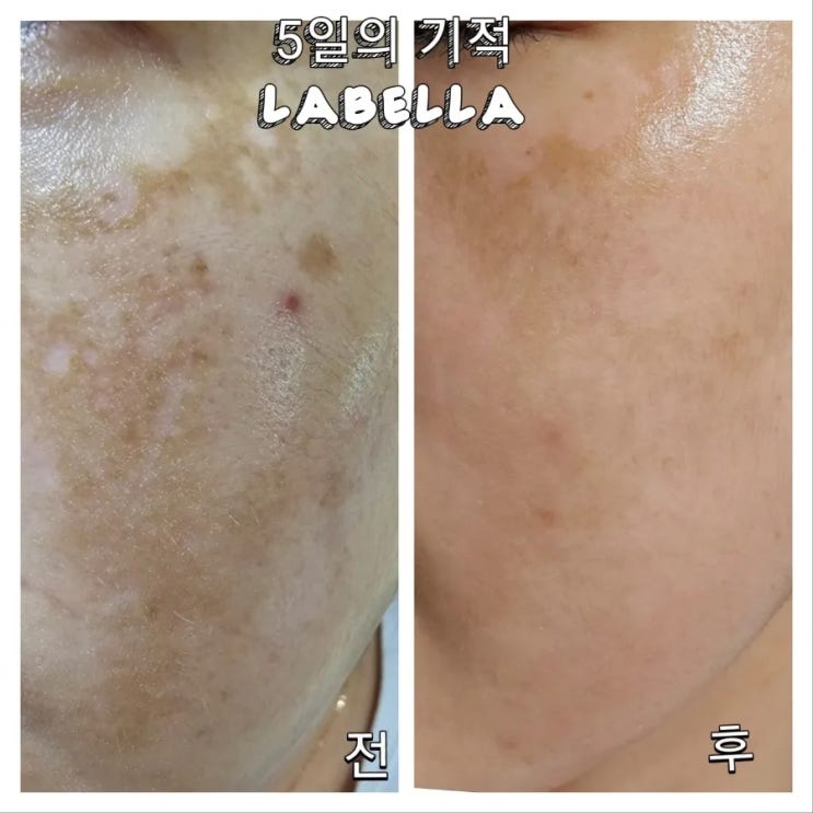 레이저로 안 없어지는 기미 필자주름 눈가 다크써클모공 인체줄기세포 콜라겐필름갈바닉마스크팩 라벨라 5일의기적으로